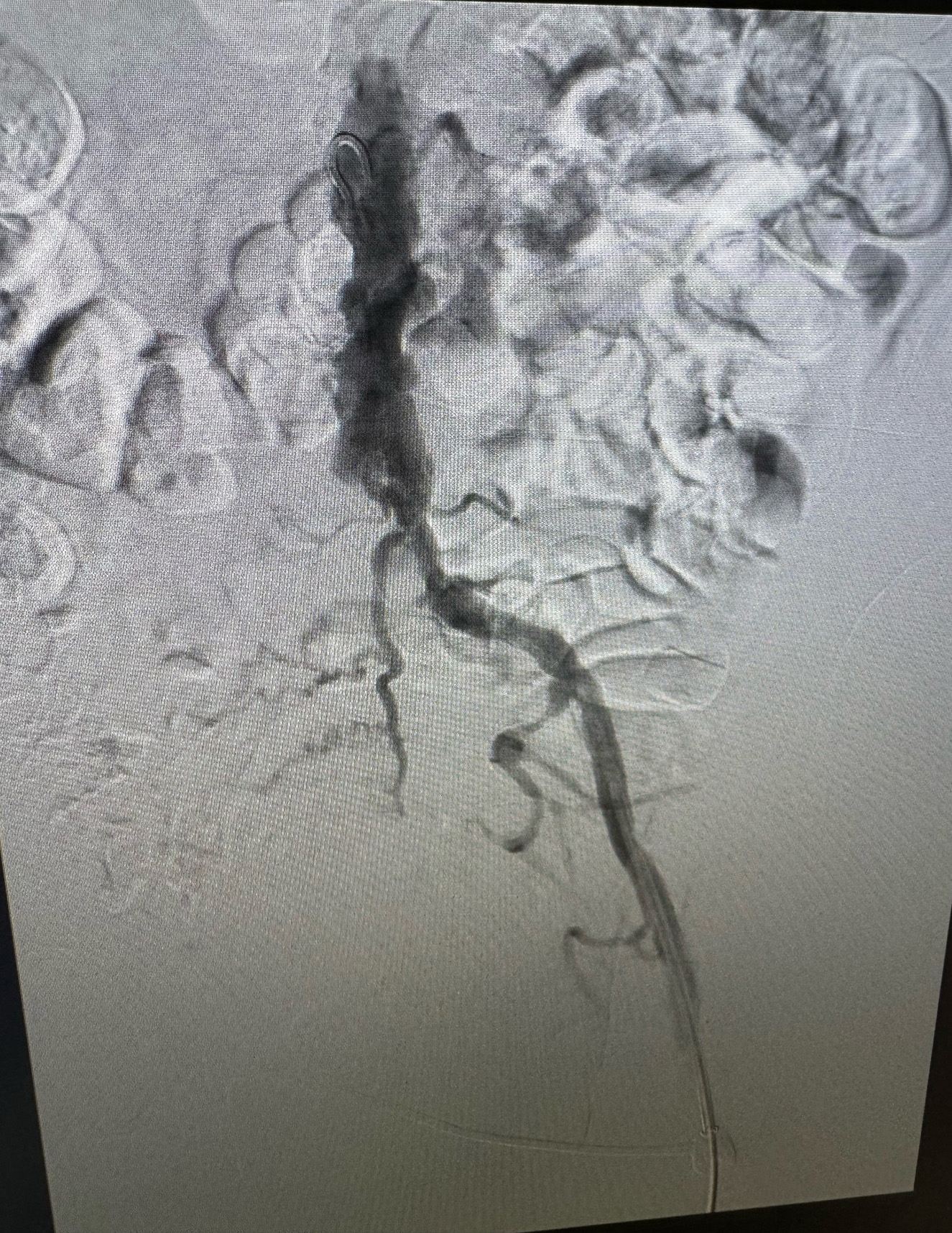 Procedure Reopens 100% Blocked Artery Without Surgery – Oracle Heart ...
